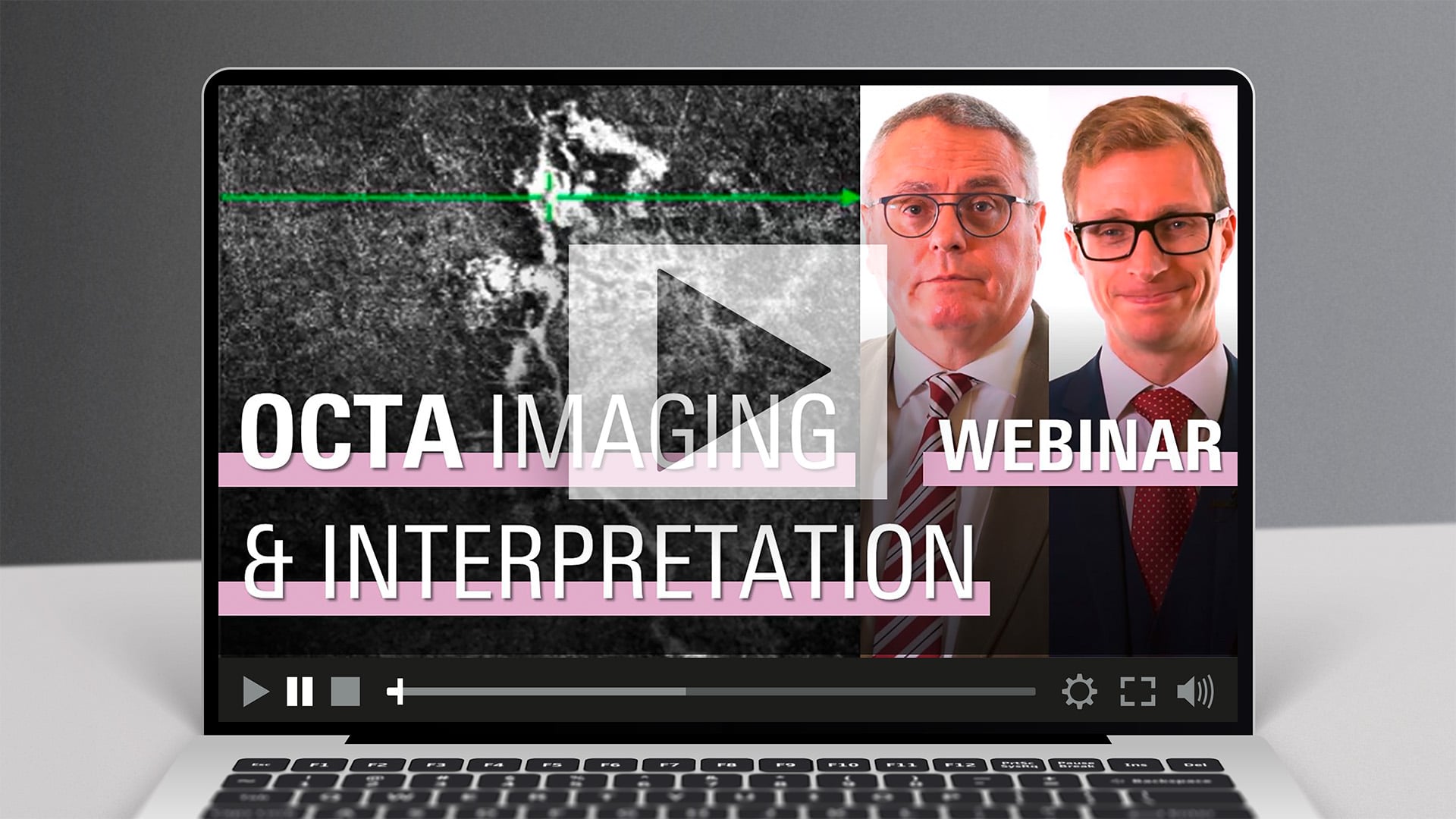 OCT Angiography Imaging & Interpretation: Macular Neovascularization ...